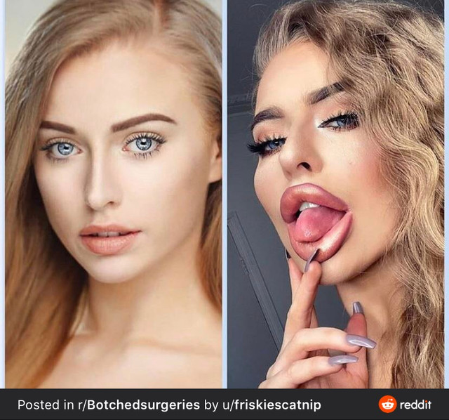 Lip Filler Before And After Very Thin Lips Reddit | Lipstutorial.org