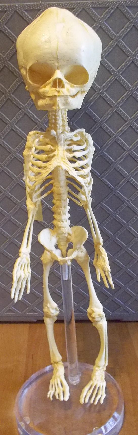 Six-inch human skeleton discovered with multiple disease-associated ...